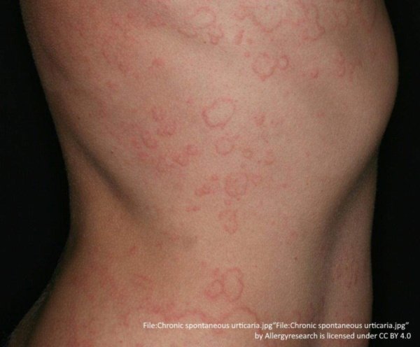 37 Detailed Pictures of Hives on Skin - Allergy Preventions