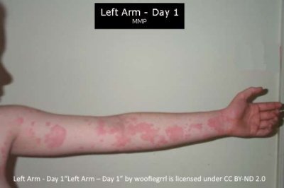 37 Detailed Pictures of Hives on Skin - Allergy Preventions