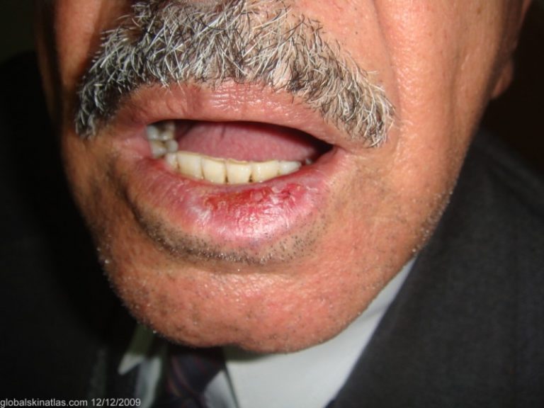 30 Eye-Opening Pictures of Lichenoid Dermatitis