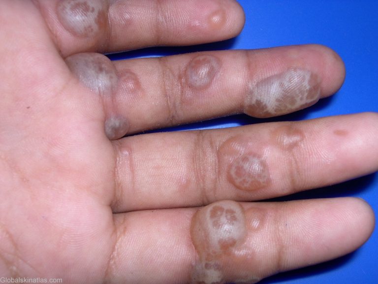 Spongiotic Dermatitis: Causes, Treatments, and Prevention Measures
